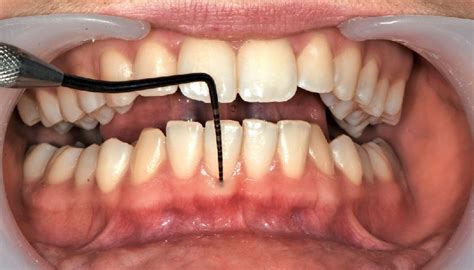 Clinical Measurement Of Probing Depth Ppd Download Scientific Diagram