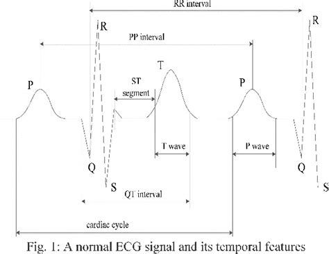 Figure 1 From The Qrs Complex Detection Of Ecg Signal Based On Ipcmm