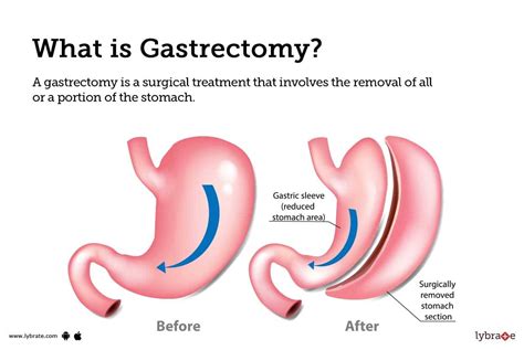 Gastrectomy Causes Symptoms Treatment And Cost
