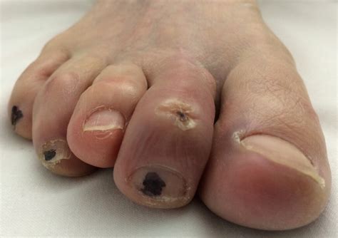 Mallet Toe Mallet Toe Deformity At The DIP Joint