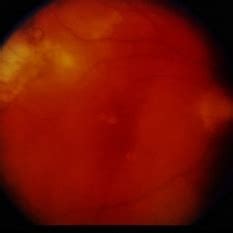 Toxoplasmosis Chorioretinitis Recurrence Retina Image Bank
