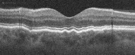 Undulation Of The Retina On Oct Ophthafellow