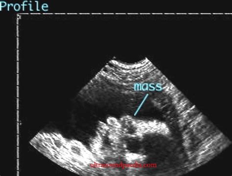 Encephalocele Frontoethmoidal Ultrasoundpaedia