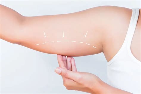 Arm Lift Surgery In Islamabad Pakistan Brachioplasty Experts