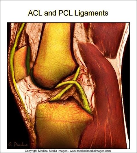 3 D Color MRI Of The Knee Joint Showing Normal ACL And PCL Ligaments A