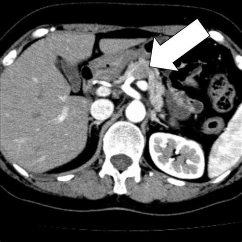 An Abdominal Ct Scan Revealed A 2 Cm Mass With Mild Contrast Effect In