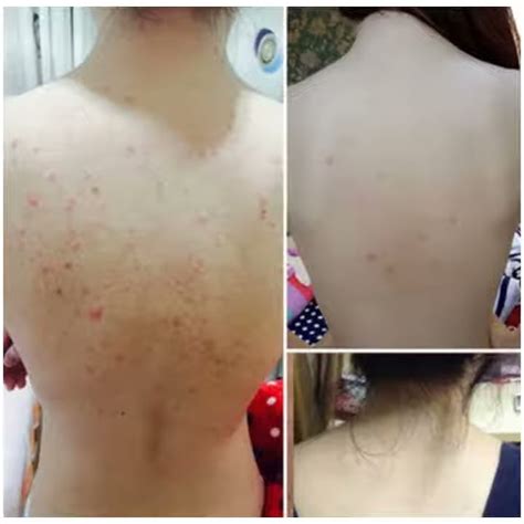 Beely彼丽茶树控油祛痘美背液 去背部痘痘胸前痘痕全身滋润正品 Youtube