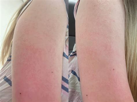 Beforeandafter One Week Of Using Amlactin Kp Bumps Be Gone 15 Lactic