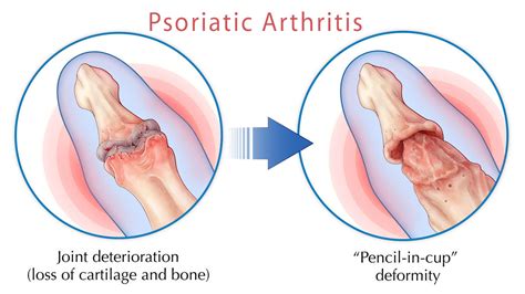 The Heartbreak Of Psoriatic Arthritis Seriously — Science Source