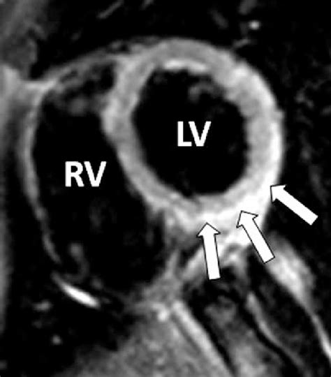 Cardiac Magnetic Resonance Imaging Of A 52 Year Old Woman With Systemic