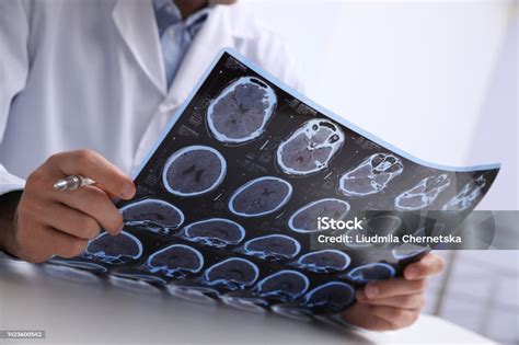 의사가 진료소의 테이블에서 다발성 경화증 환자의 Mri 이미지를 검사 근접 촬영 뇌종양에 대한 스톡 사진 및 기타 이미지