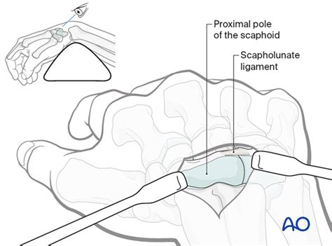 Dorsal Approach To The Scaphoid