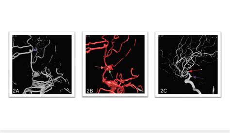 A Saccular Aneurysm At The Proximal End Of The Fenestrated Right A1