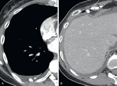 The Pleura Diaphragm And Chest Wall Clinical Tree