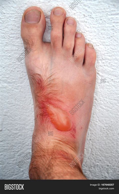 Phytophotodermatitis Image And Photo Free Trial Bigstock