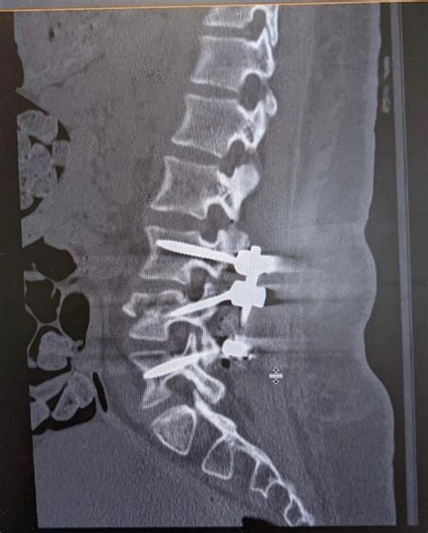 Update I Have A Diagnosis For My L4 Lytic Lesion And No One Guessed Even Close Info In