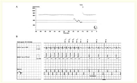 Example Of Intrathoracic Electrograms Of Atrial Tachycardia A A Flow Download Scientific