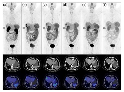 68ga Dota E Crgdfk 2 Petct Scan A Baseline Petct In Maximum
