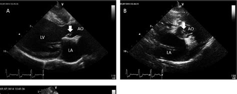 Two Dimensional Echocardiogram Images Right Parasternal Long Axis A