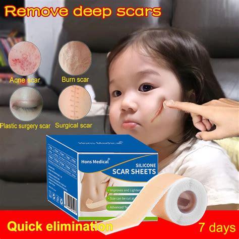 Scar Removal Medical Silicone Scar Sheet 4cmx50cm Scar Gelkeloid Scar
