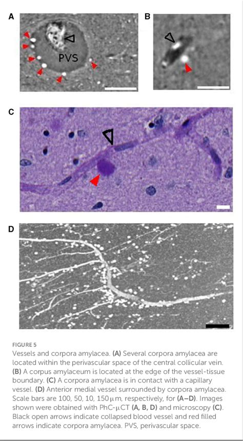 Figure 1 From Distribution Of Corpora Amylacea In The Human Midbrain Using Synchrotron