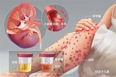 紫癜性肾炎，7大典型症状 知乎