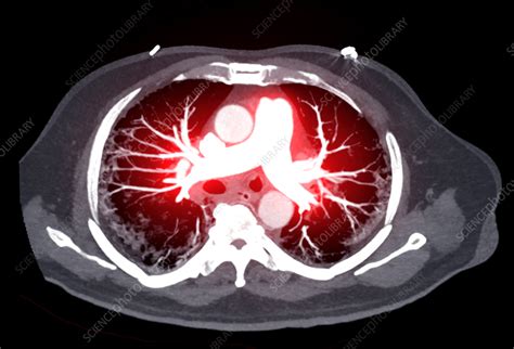 Pulmonary Artery Ct Scan Stock Image F0377325 Science Photo Library
