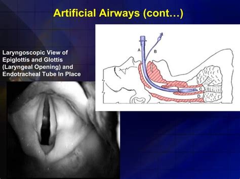 Airway Obstruction And Management Ppt