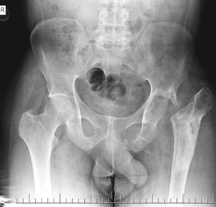 Osteomyelitis Radiology Reference Article Radiopaedia Org