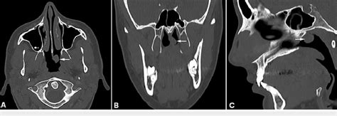 Sinus Ct Scan A Polypoid Mass White Arrow 11x9x15mm Deriving From