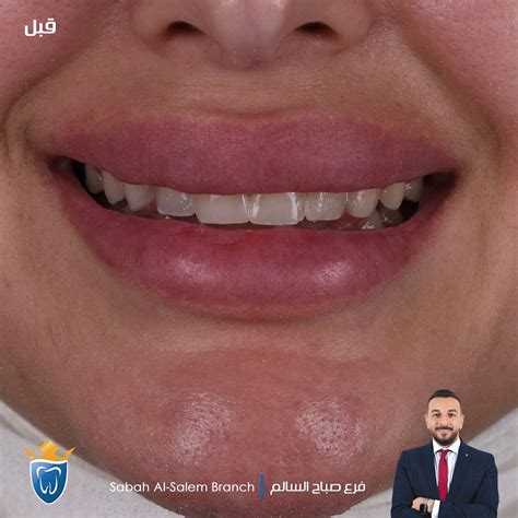 قبل وبعد Before And After مركز تيجان افضل عيادة اسنان في الكويت