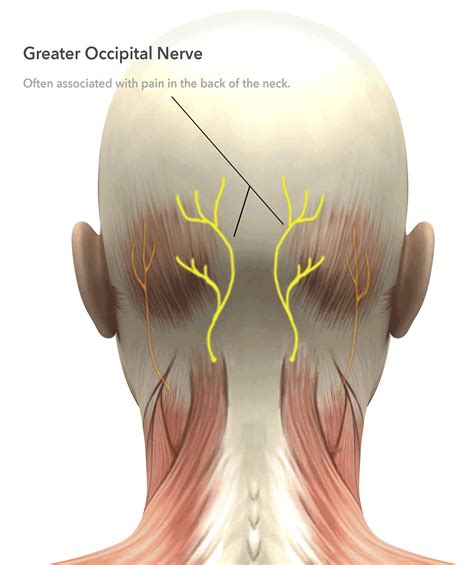 Neuralgia Oksipital Penyebab Gejala Dan Pengobatan Idn Medis