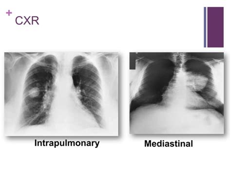 Lung Cancer Pathology And Clinical Pptx