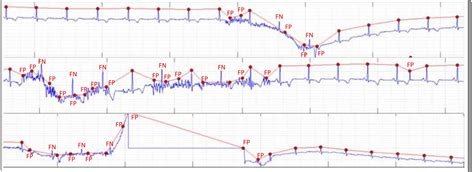 Typical Holter Ecg Segments From The Record Of Patient 6 In