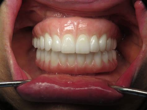 Pterygoid Implants To Avoid Zygomatic Implants And Sinus Lifting