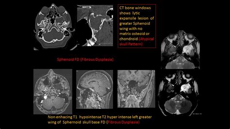 Sphenoid Dysplasia