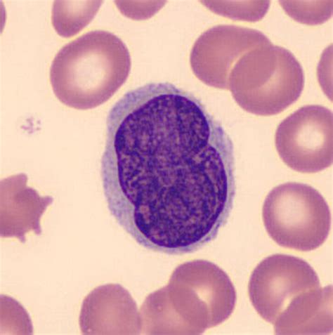 Non Hodgkins Lymphoma Cells