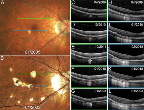 Representative Case Of Punctate Inner Choroidopathy Pic Associated
