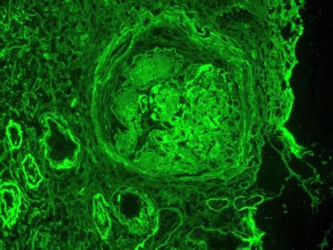 Pathology Outlines Igg4 Related Disease