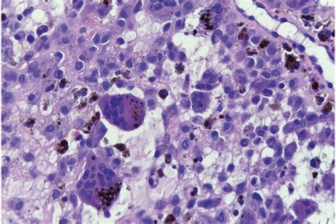 50 Facts About Pigmented Villonodular Synovitis