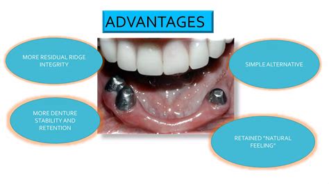 Tooth Supported Overdentures Pptx