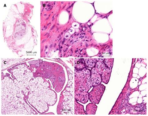 Liposarcoma Of The Breast Arising In A Malignant Phyllodes Tumor A