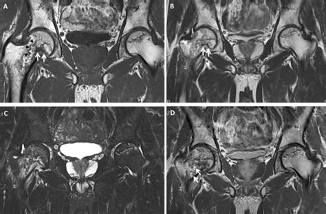 Coronal T1 Weighted A And T2 Weighted B Magnetic Resonance Images