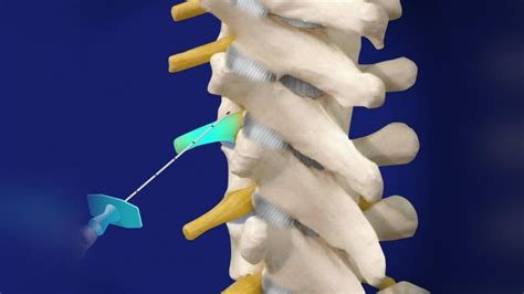 Spinal Injections For Back Pain