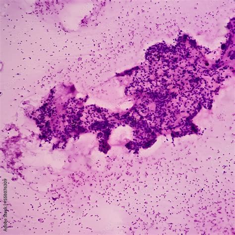 Thyroid Nodule Fna Cytology Cellular Follicular Lesion Microscopic