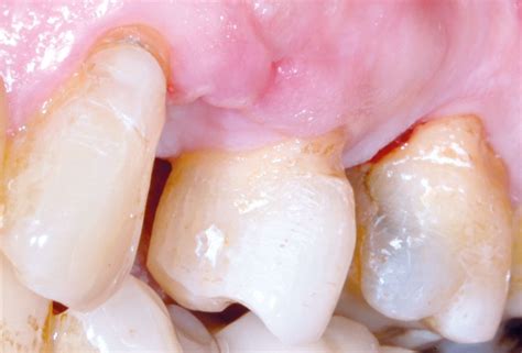 Socket Preservation With Permamem® Dr P Papi Indication Matrix