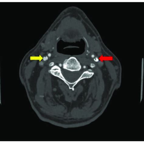 Subocclusion In The Proximal Segment Of The Left Internal Carotid