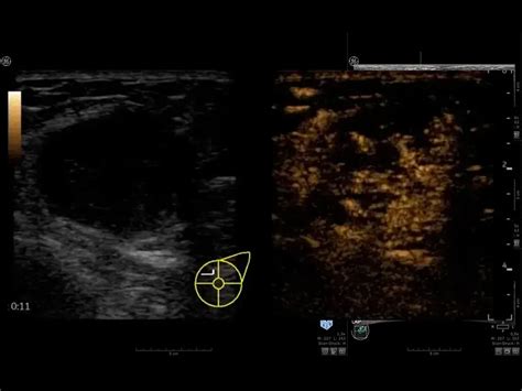 Breast Ultrasound Personalised Breast Care Logiq™