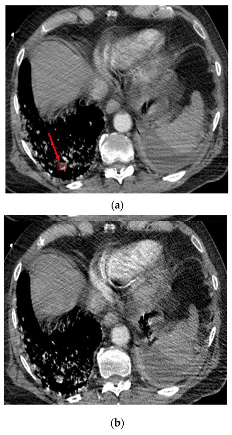 Automated Detection Of Pulmonary Embolism From 59 Off