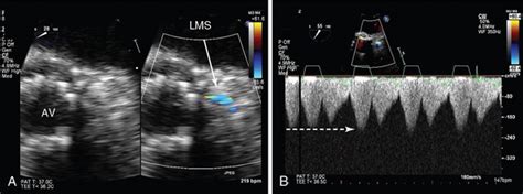 Transesophageal Echocardiography Radiology Key